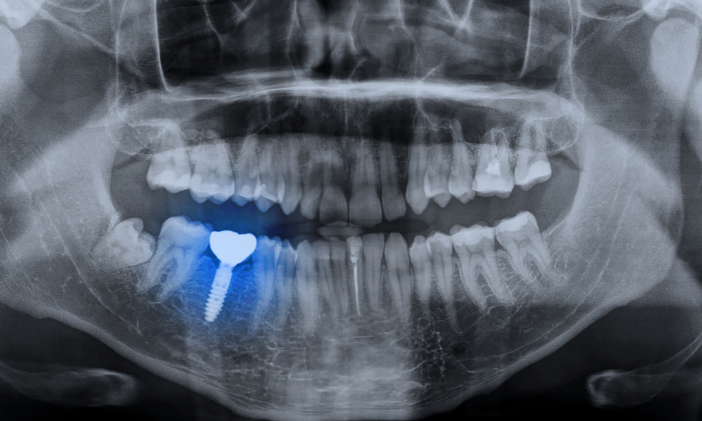 Signs That You Need Dental Implants - Beauty and the Mist