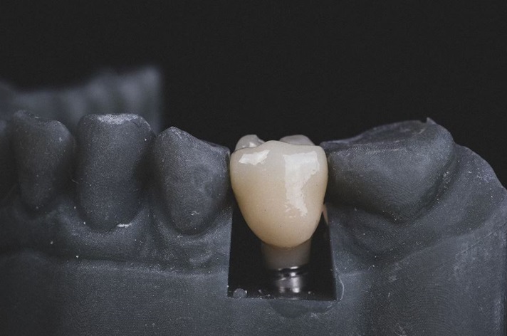 A Step-by-Step Guide to Preparing for Dental Implants - Beauty and the Mist